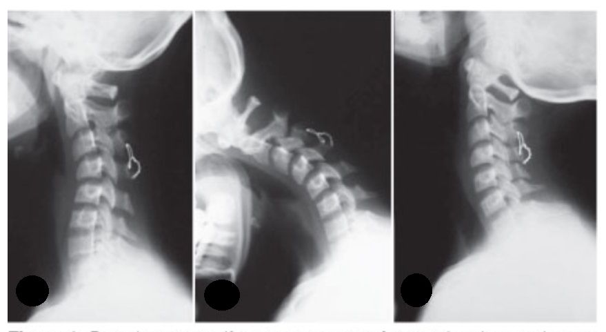 Rx Dinâmico da Coluna Cervical - Orto Center