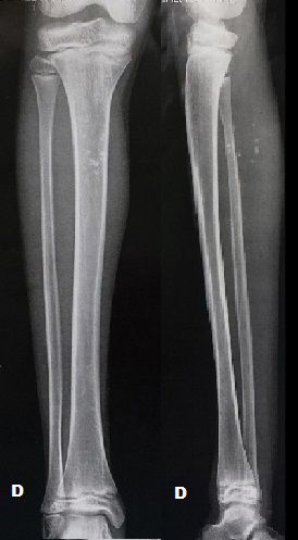 Rx da Perna/Tíbia/Fíbula - Orto Center