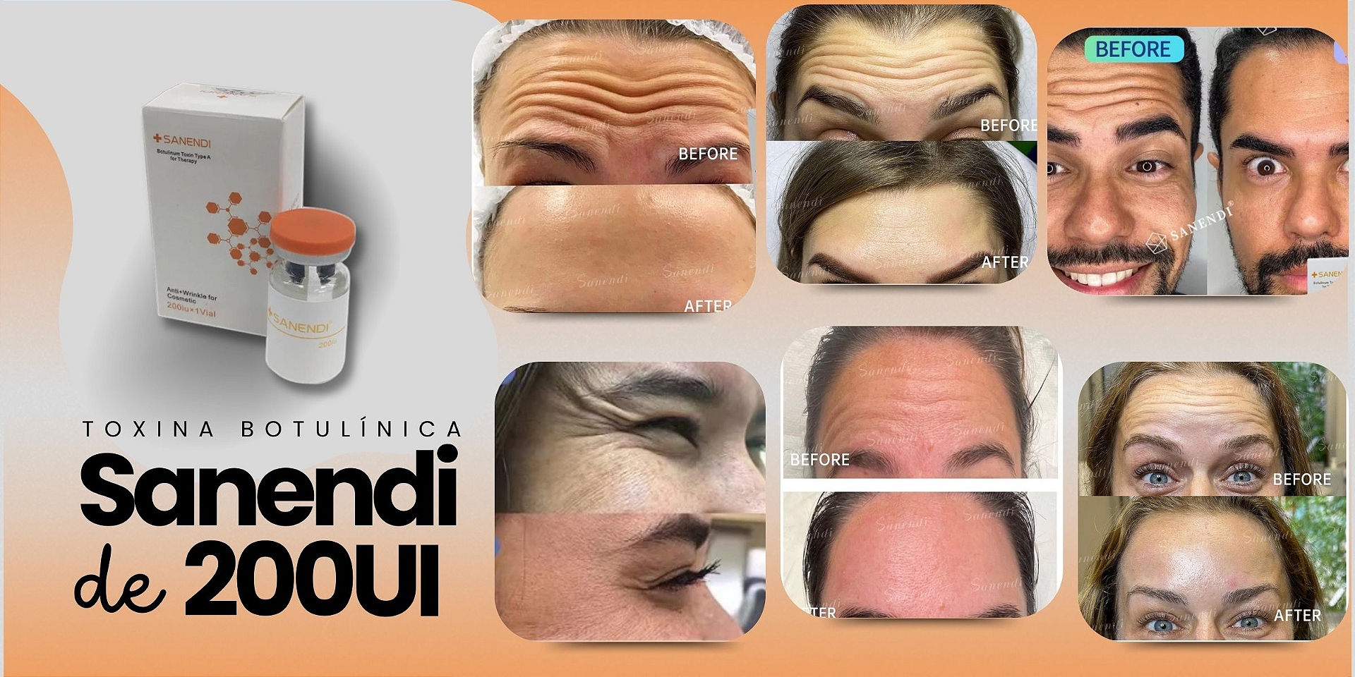 Toxina Botulínica Botox 100UI - Tipo A - Philippe Souza Store