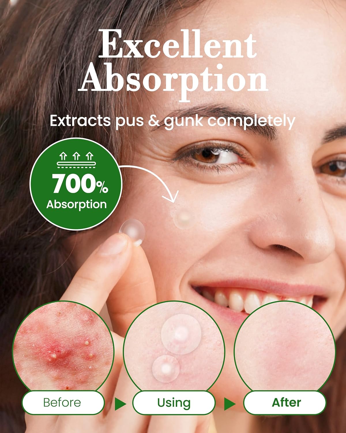 Adesivos para Acne, Invisible Spot Patch, 96 Unidades, Troubless - MAGAM