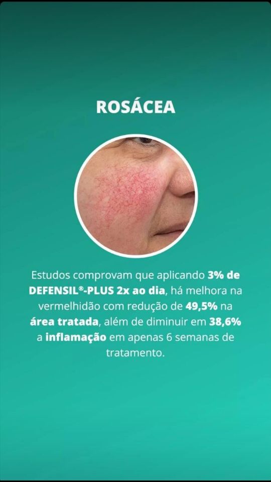 Rosácea Gel Creme - Physavie 2%, Telangyn 2%, Defensil Plus 3%, Aveia ...