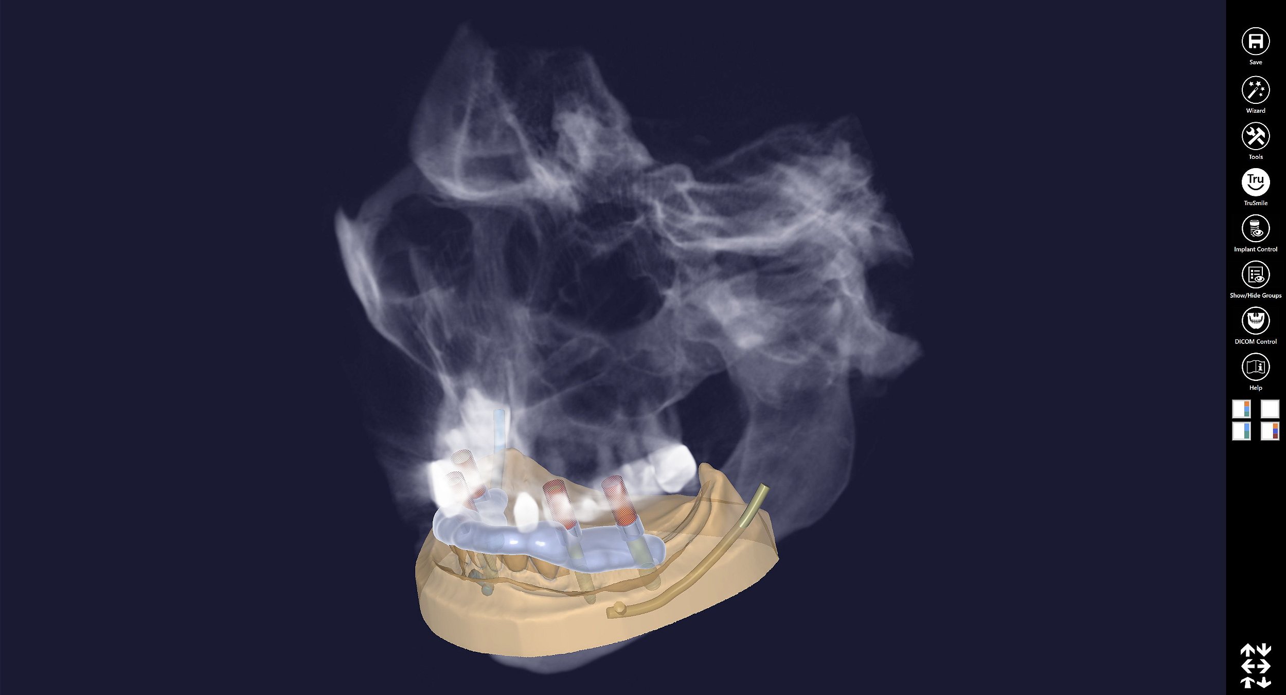 Smart Dent - Exocad - Exoplan - SMART DENT