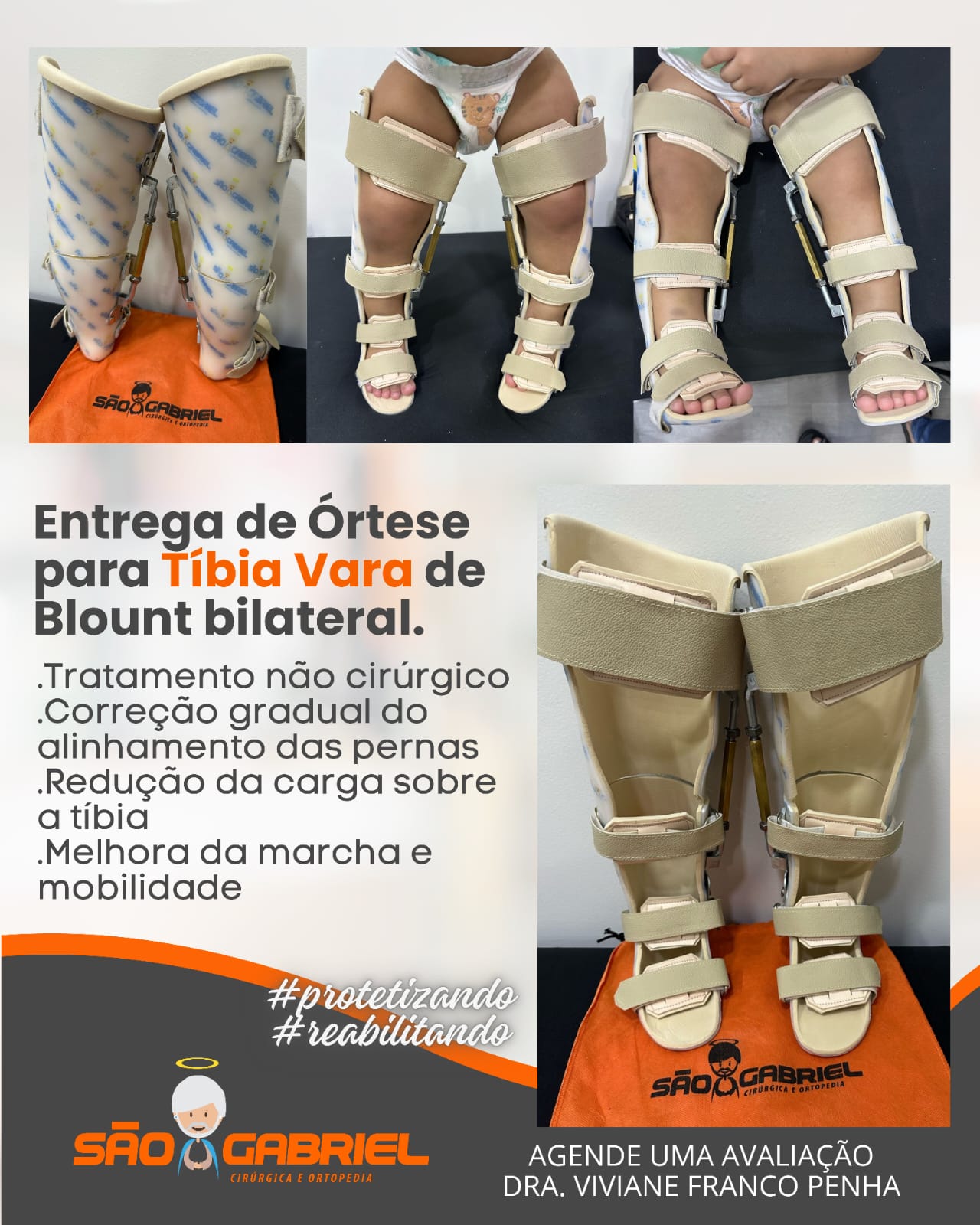 Órtese sob medida para Tíbia vara de Blount Bilateral - Cirúrgica São ...