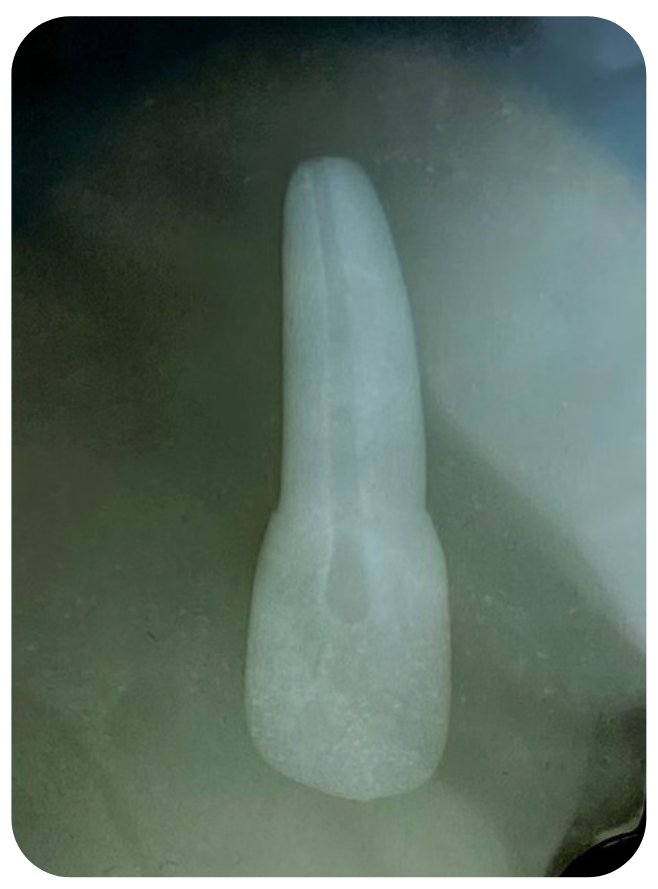 DENTES ENDO (DE 21 À 27 E 31 À 37) POLPADO RADIOPACOS - Orais Manequins ...