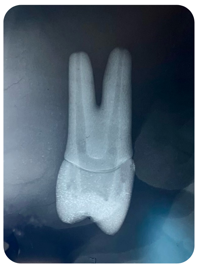 DENTES ENDO (DE 21 À 27 E 31 À 37) POLPADO RADIOPACOS - Orais Manequins ...