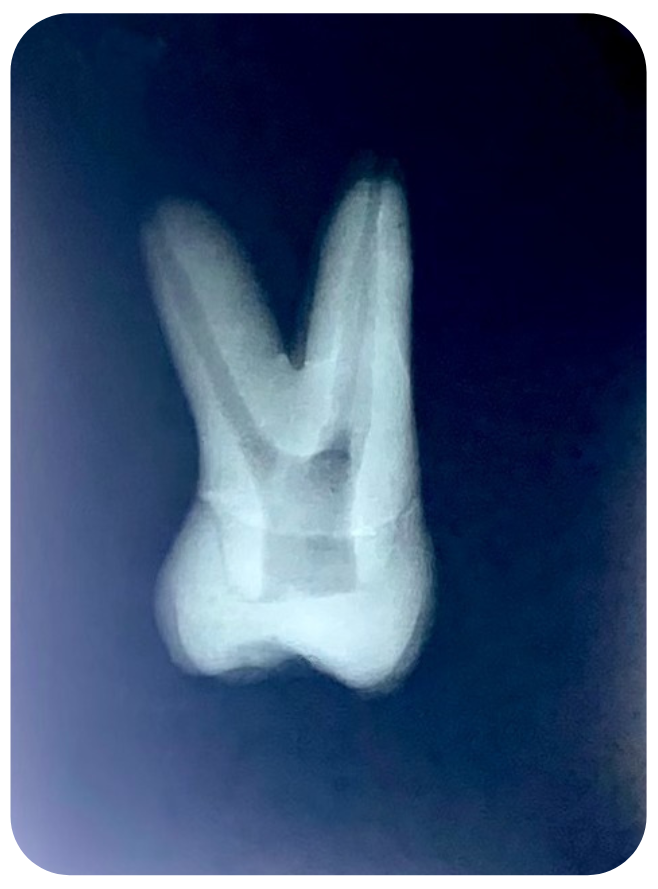 DENTES ENDO (DE 21 À 27 E 31 À 37) POLPADO RADIOPACOS - Orais Manequins ...