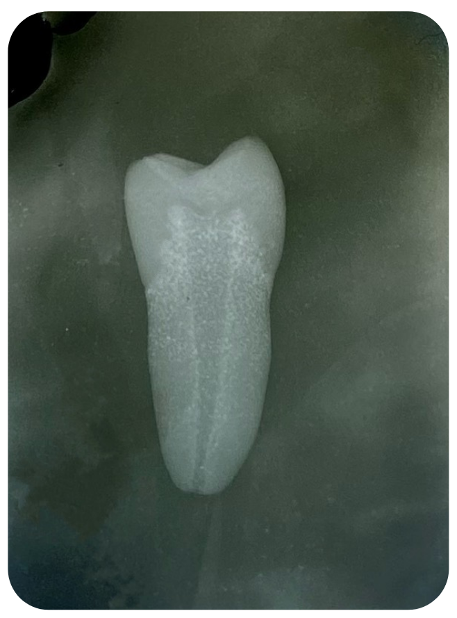 DENTES ENDO (DE 21 À 27 E 31 À 37) POLPADO RADIOPACOS - Orais Manequins ...