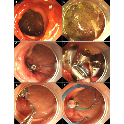 Endoloop - Manancial Medical