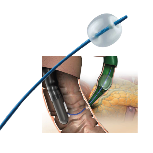 Balão Extrator (Recuperação de Pedra) 12, 15, 18 mm 7 Fr 200 cm ...