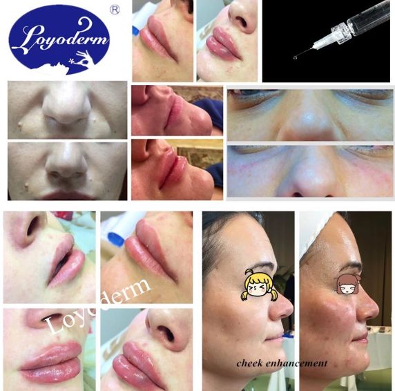 Preenchedor Ácido Hialurônico Injetável Reticulado Fine Lido 10 ml ... Preenchedor Ácido Hialurônico Injetável Reticulado Fine Lido 10 ml ...