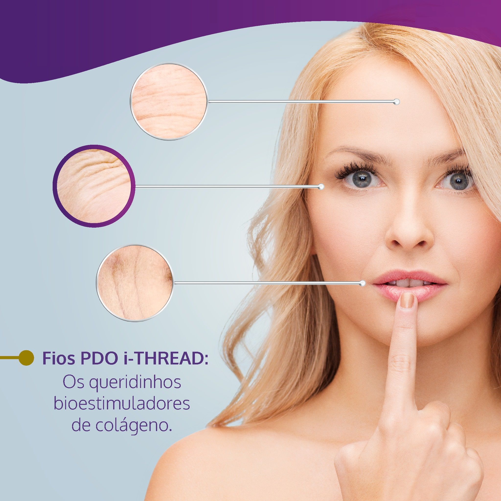 Fios de PDO Mono Liso 30G x 25mm ( Pacote 10 unidades) Loyoderm ...