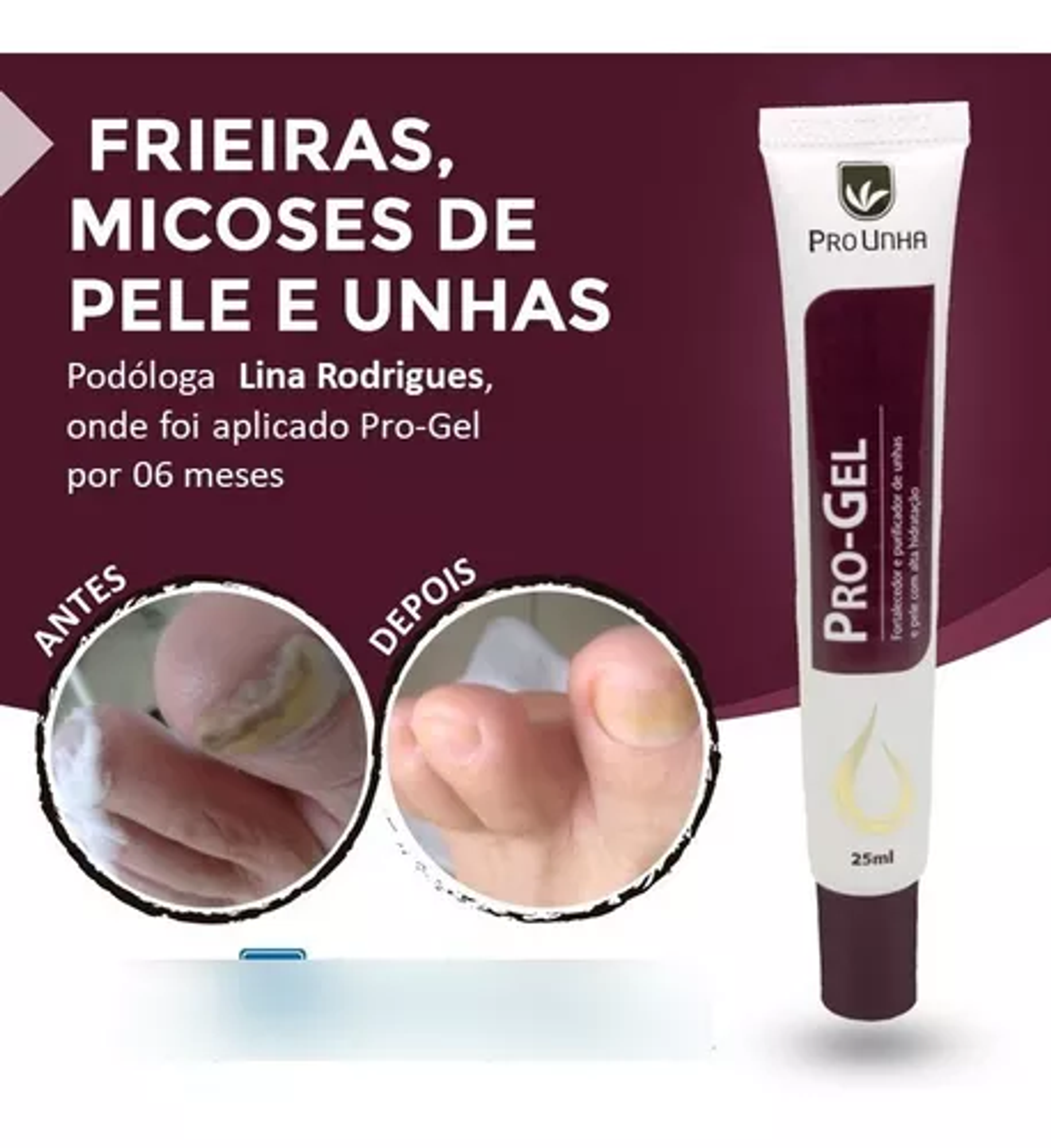 Gel para unha progel pro gel micose - Cirúrgica Doutor MED
