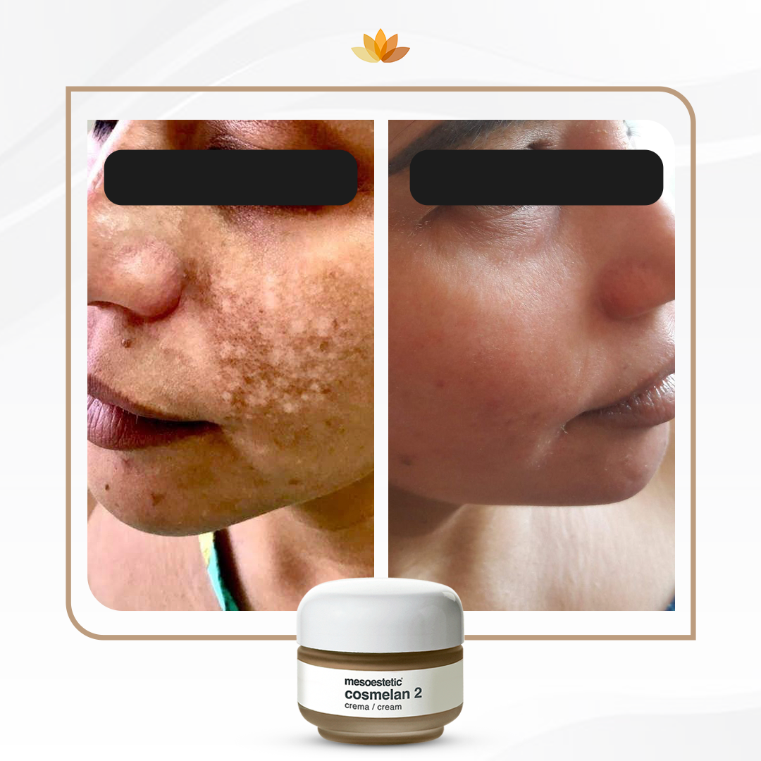 Cosmelan Pack Mesoestetic - Tratamento completo da linha Cosmelan ...