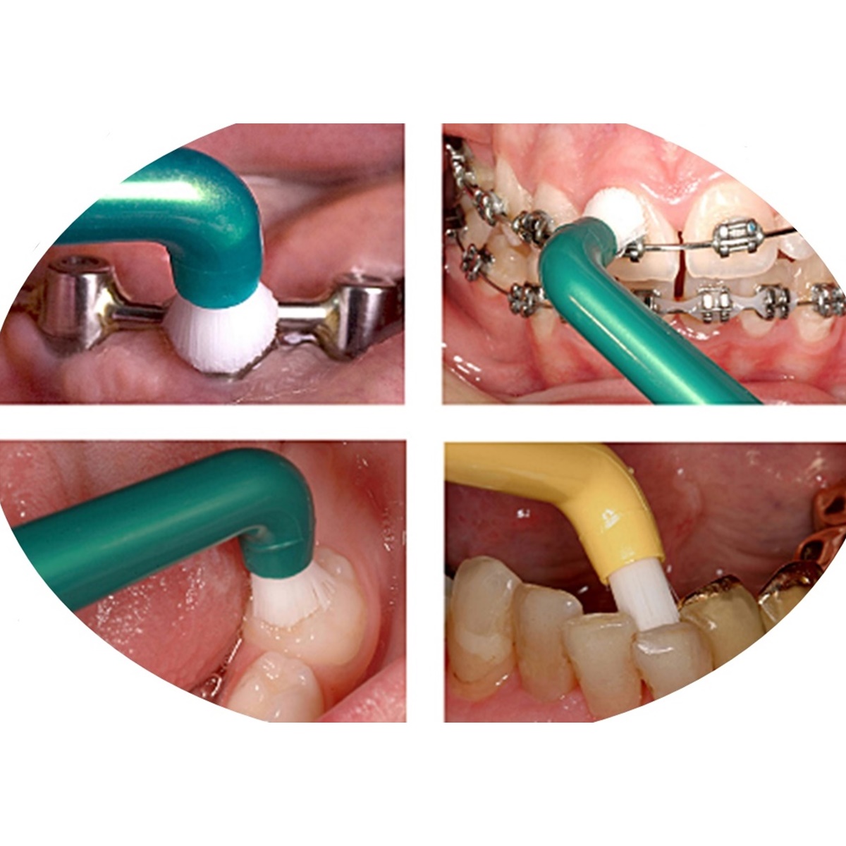 Kit 3 Escova dental Unitufo Cônica Medfio - Resina e Arte