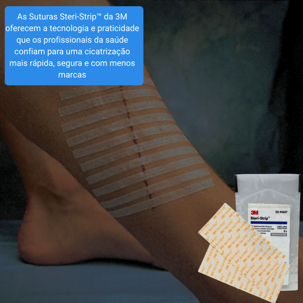 Curativo Steri-Strip Ponto Falso 12mm x 100mm C/6 Tiras - 3M - RareMed ...