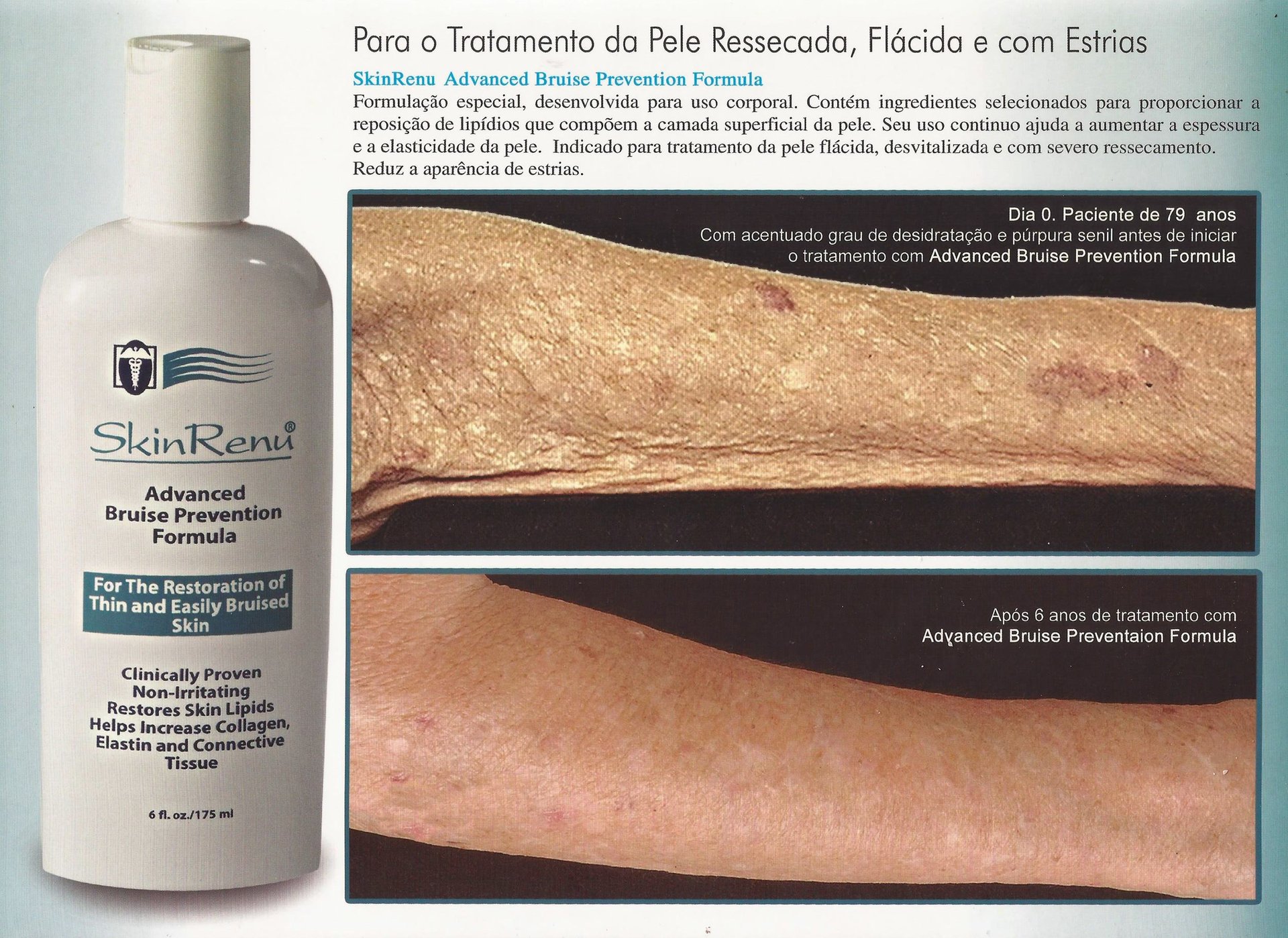 ADVANCED BRUISE PREVENTION FORMULA - SKIN RENU - Celia Bannitz ...