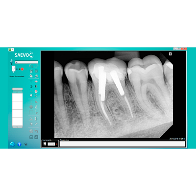Sensor para Radiografia Digital | Dental Odonto
