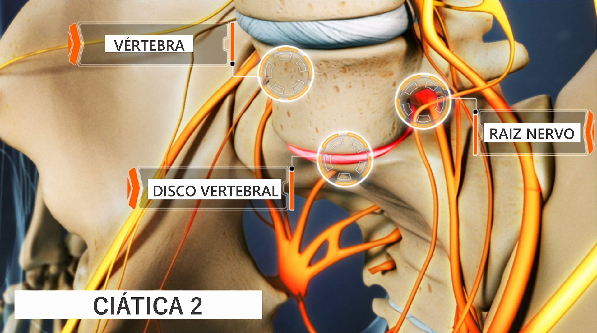 CIÁTICA - imaterapia