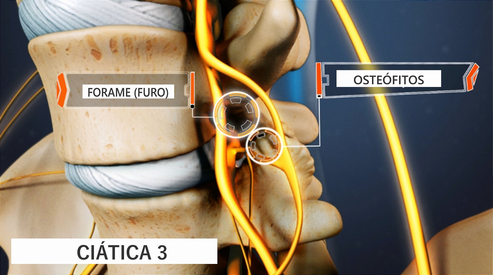 CIÁTICA - imaterapia