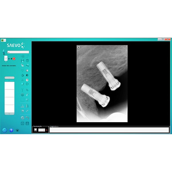 Sensor Intraoral Digital Slim Tamanho 1 T1 - Saevo | Dental Odonto ...