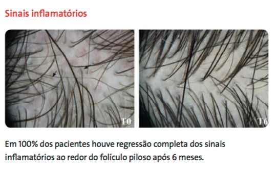 PROSTAQUINONA | Queda e aumenta a espessura capilar, uma inovação no ...
