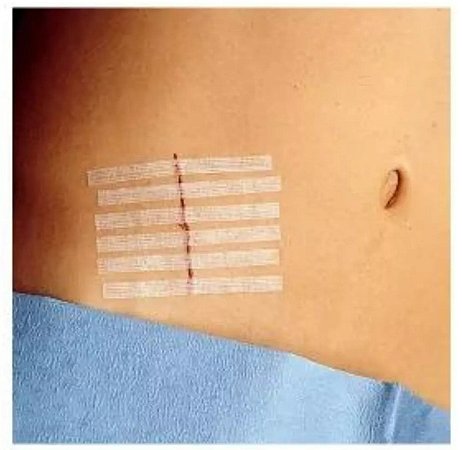 Curativo Skin-Strip Ponto Falso C/12 Tiras - Skinupper - Cirúrgica ...
