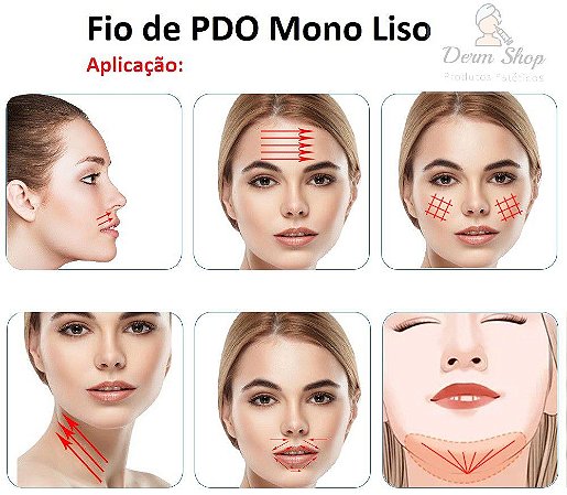 Fios de PDO Mono Liso 30G x 25mm ( Pacote 10 unidades) Loyoderm ...