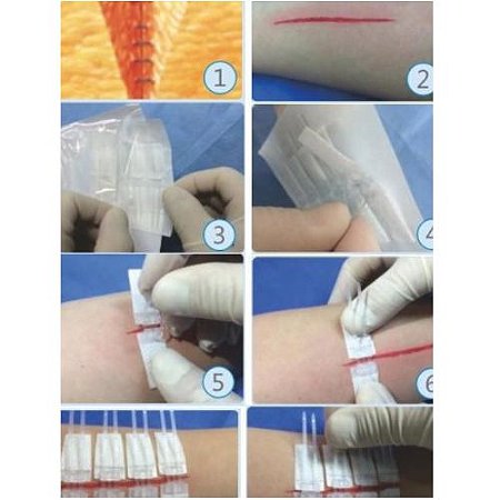 Curativo de ponto Falso - SeekMed