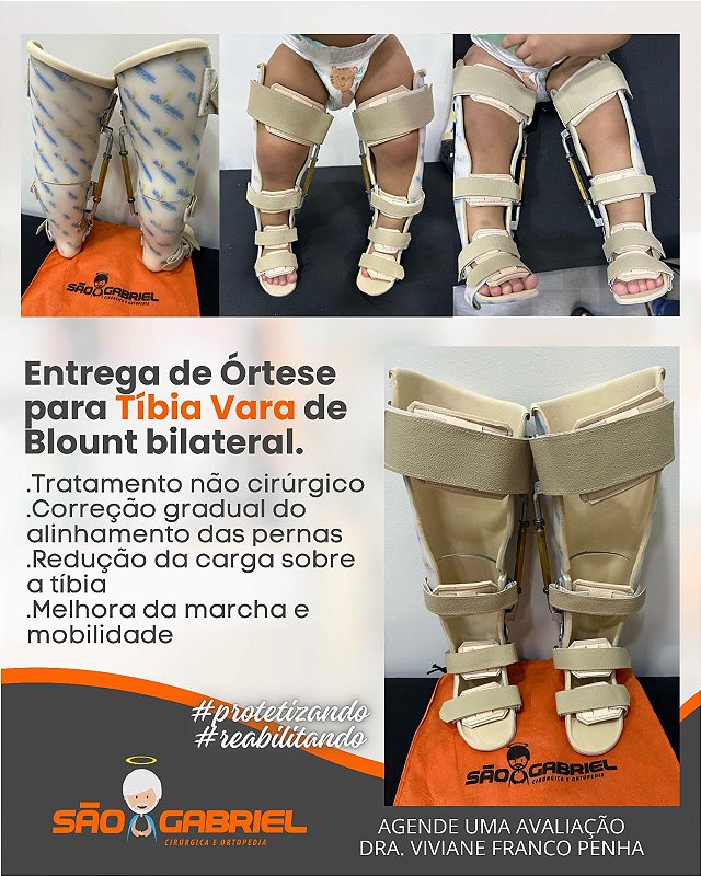 Órtese sob medida para Tíbia vara de Blount Bilateral - Cirúrgica São ...