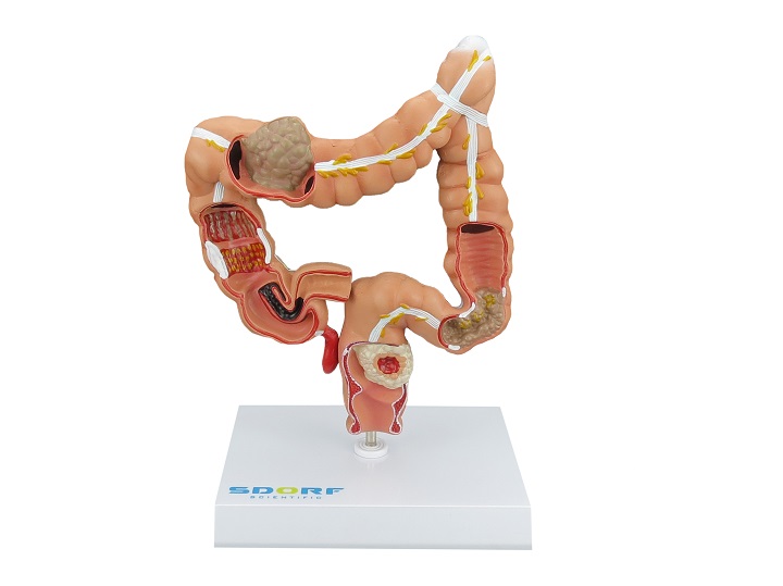 MODELO PATOLÓGICO DO CÓLON E DO RETO - Cardiomed Saúde