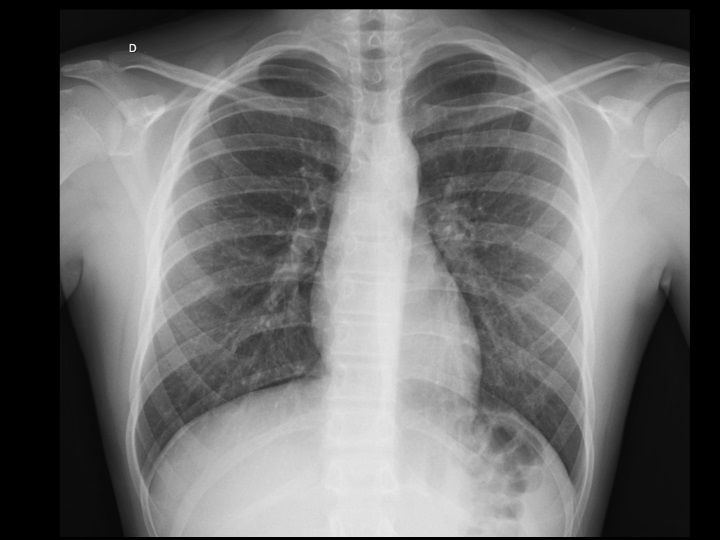 Rx do Tórax - AP - Orto Center