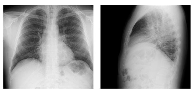 Rx do Tórax - AP/Perfil - Orto Center